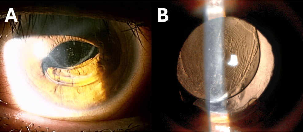 Repositioning of Sutures to Correct Subluxation of a Multifocal ...