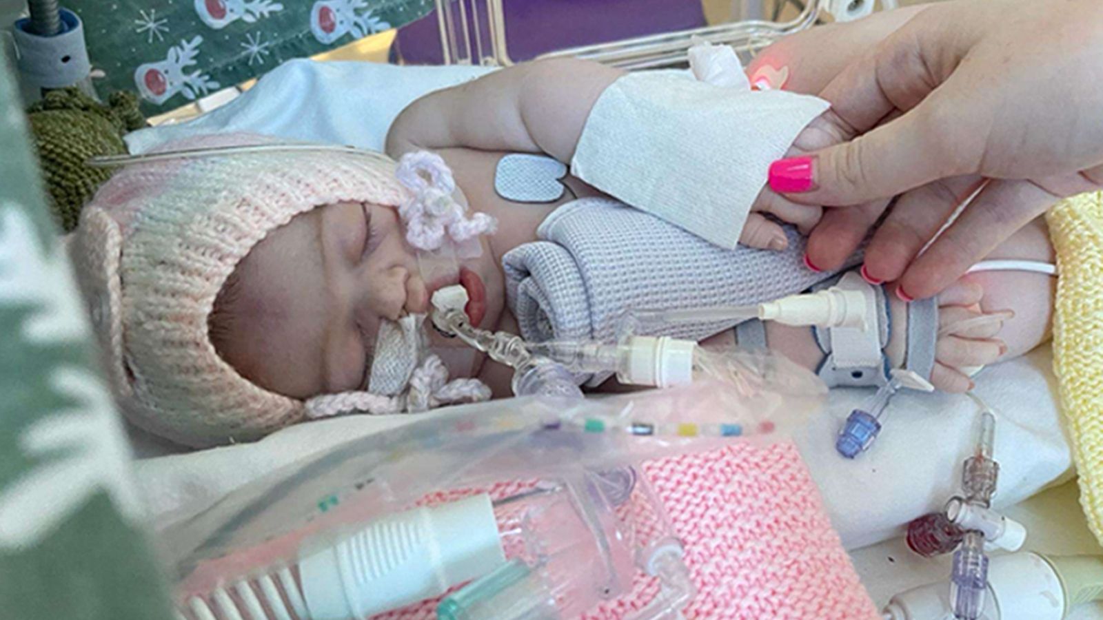 New Treatment Shows Promise for Babies with Congenital Diaphragmatic ...
